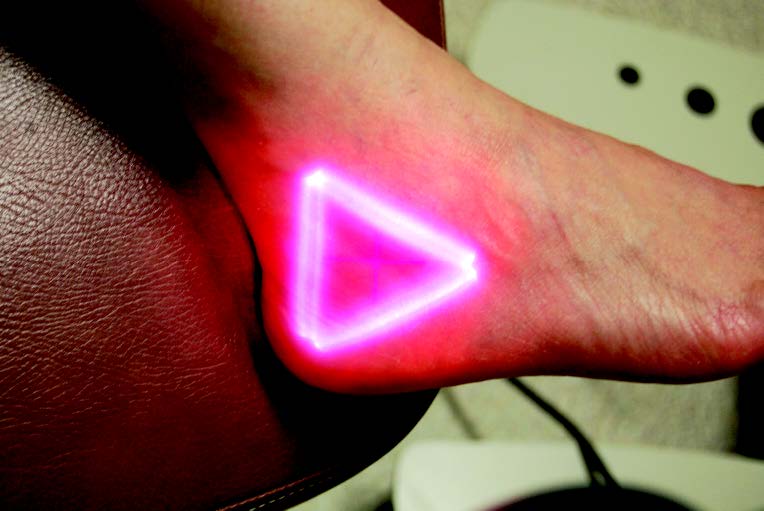 Davis Foot & Ankle Center's Tracy L. Basso, DPM on MLS® Laser Therapy ...
